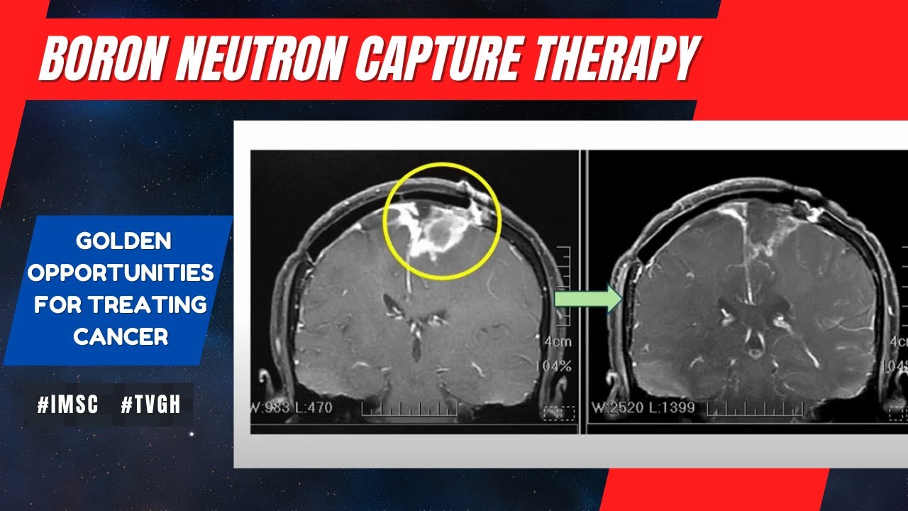 BORON NEUTRON CAPTURE THERAPY | BNCT - YouTube