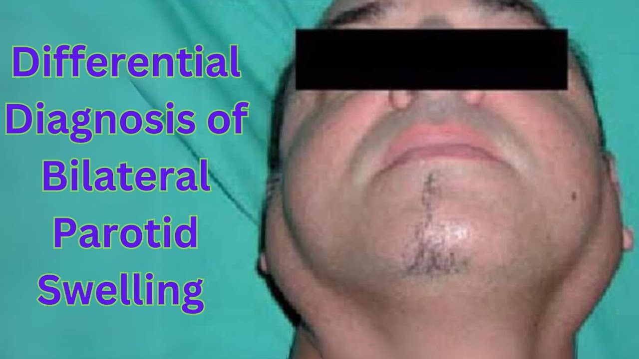 Parotid Gland Swelling Differential Diagnosis Parotid Reconstruction