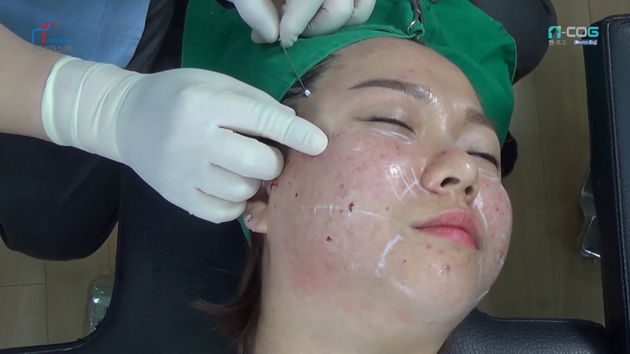 Non surgical Full Face-lift PDO thread technique | N-Cog & N-Scaffold ...