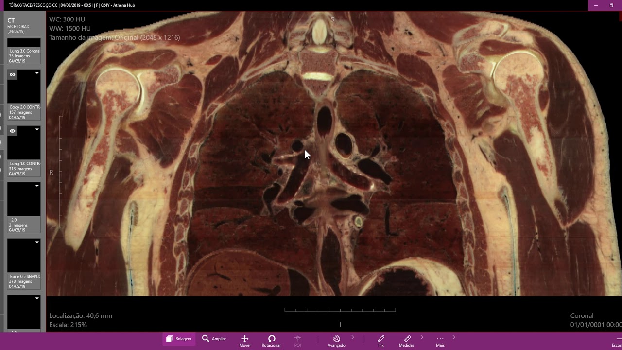 Anatomia seccional - Veia ázigos - YouTube