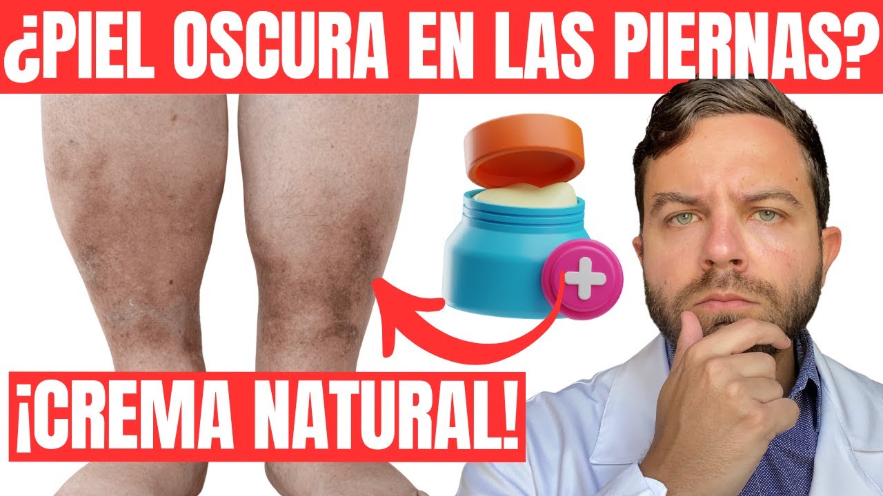 ¿Cómo QUITAR MANCHAS OSCURAS por MALA CIRCULACIÓN en las PIERNAS? - YouTube