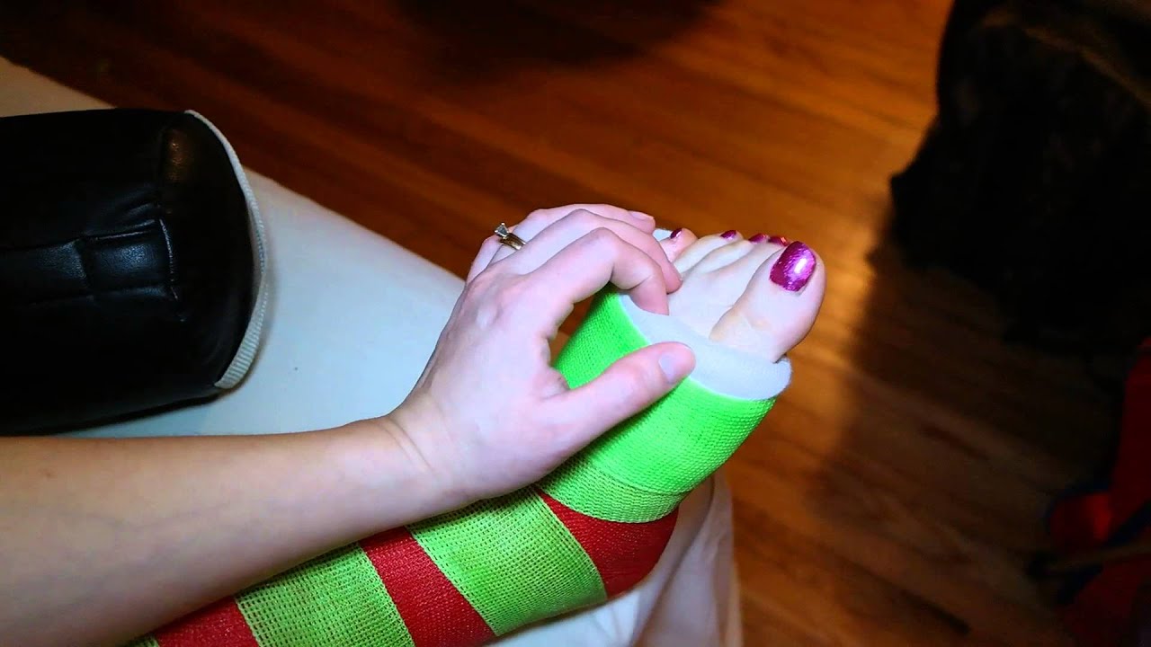 she plays with her casted toes - YouTube