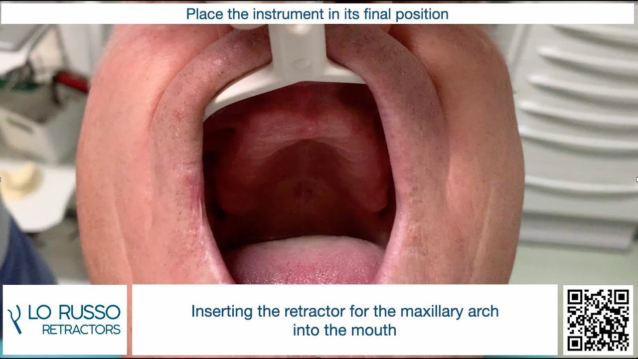 LO RUSSO RETRACTORS - inserting the instrument for the maxillary arch ...