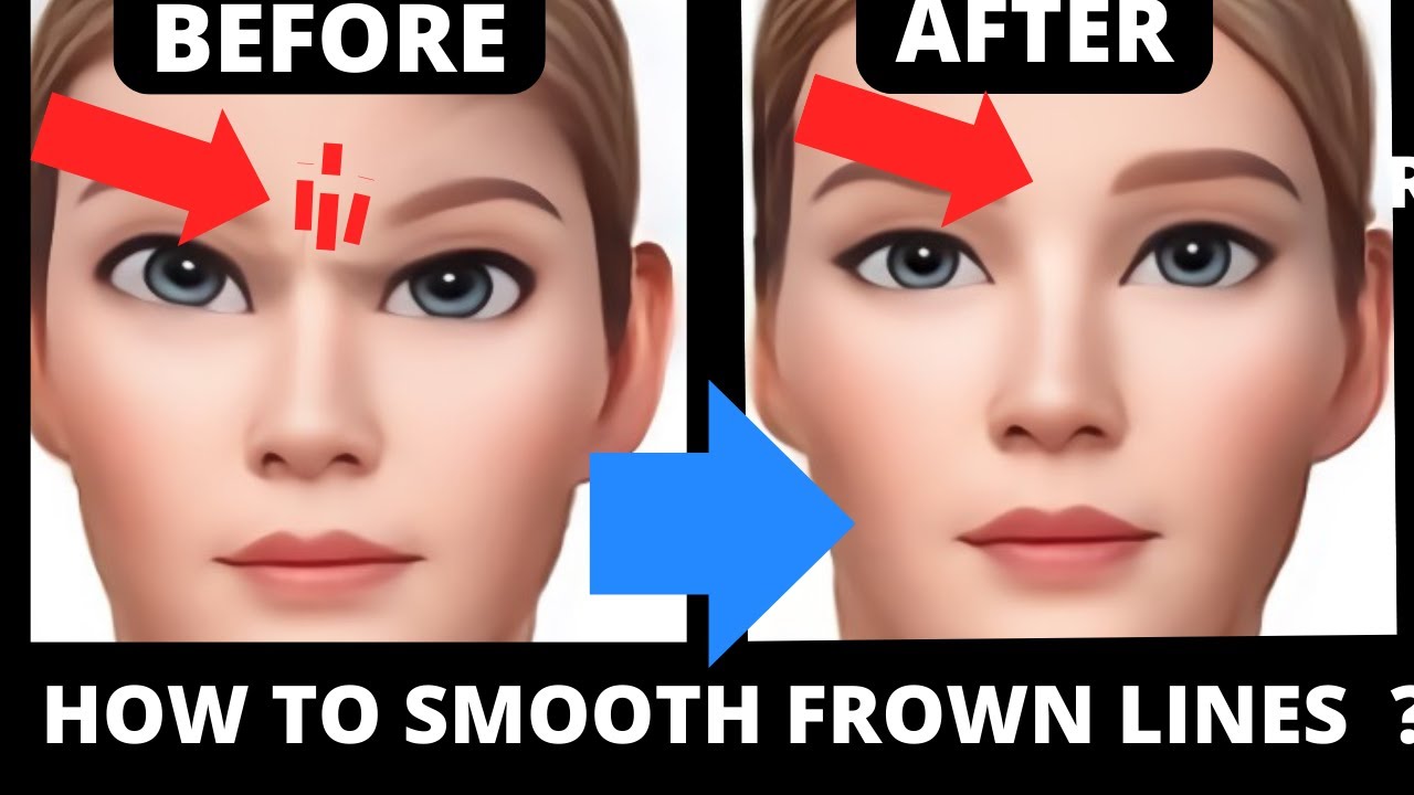 How to Remove Frown Lines Naturally | Easy Anti-Wrinkle Face Yoga ...