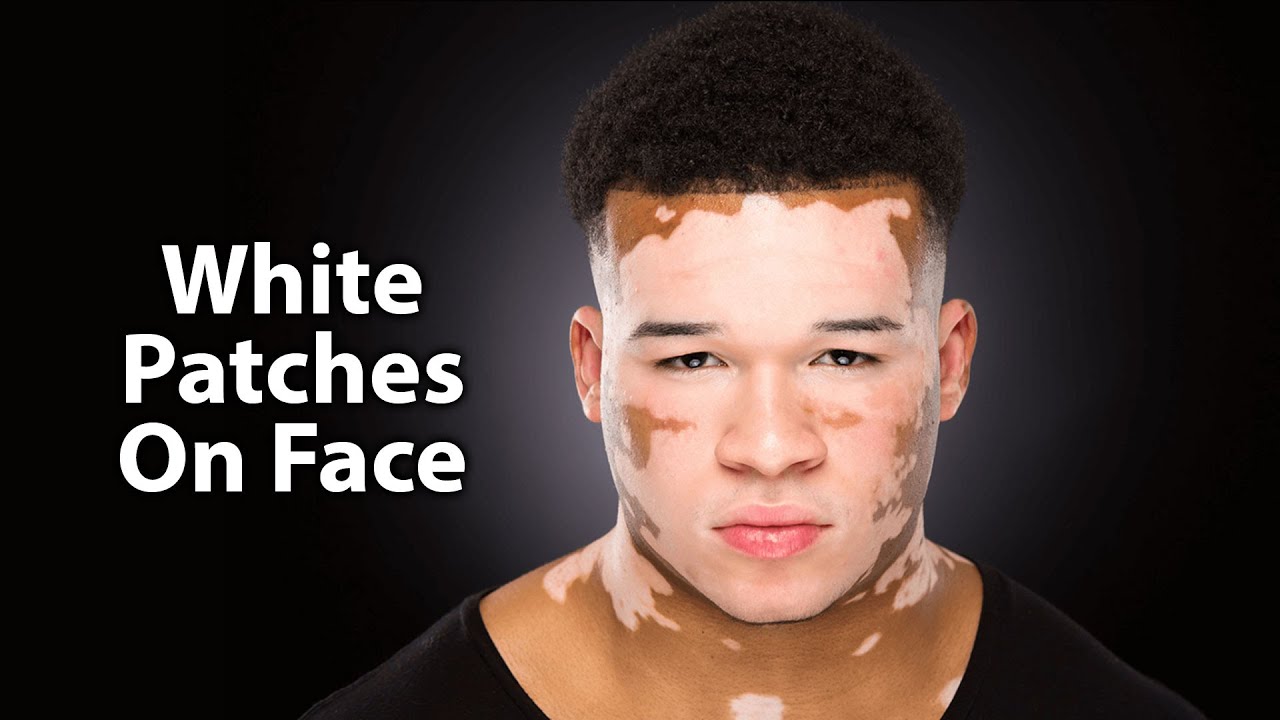 White Patches on Face | AIMIL | Care World Tv - YouTube