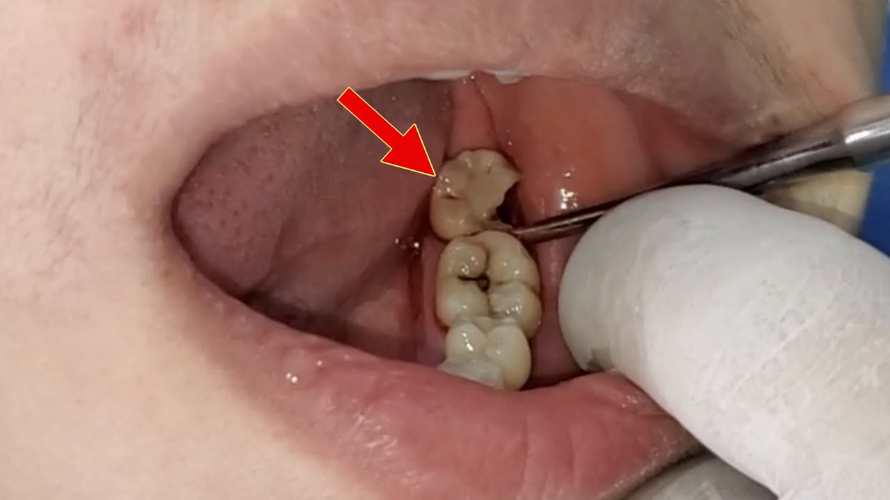 Third molar extraction #38 - YouTube