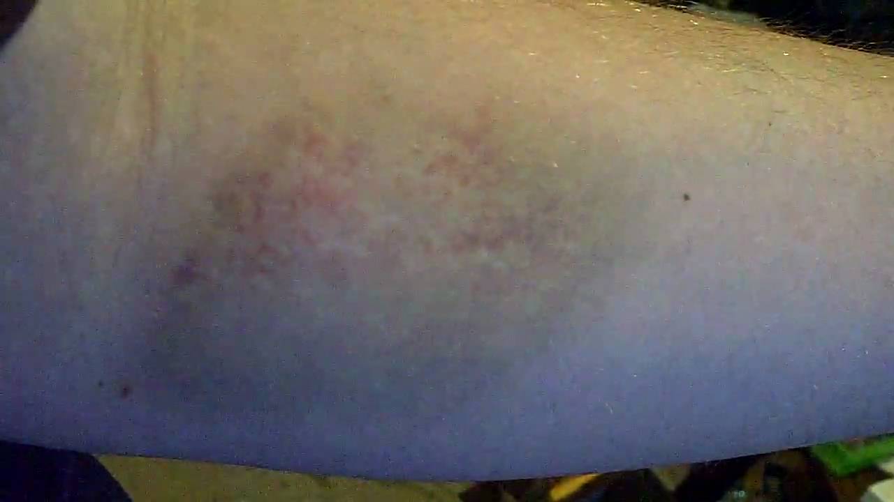 bruising from bb gun - YouTube