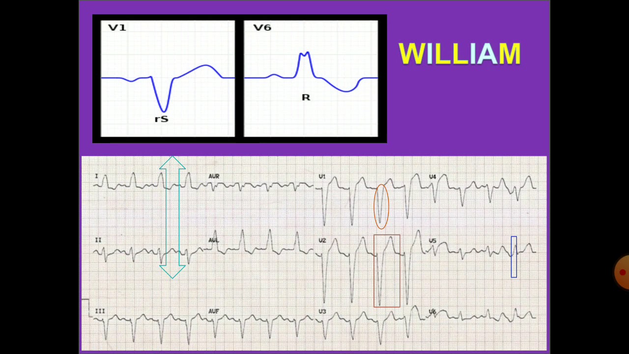 Left Bundle Branch Block made easy with ECG - YouTube