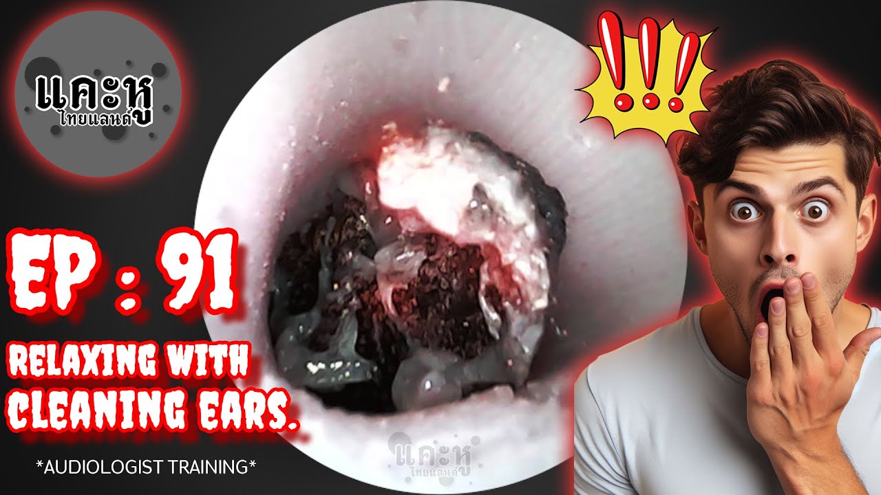 !!!อะไรอยู่ในหู!!! : What's in the ear? : EP 91 #ear #earwaxremoval # ...