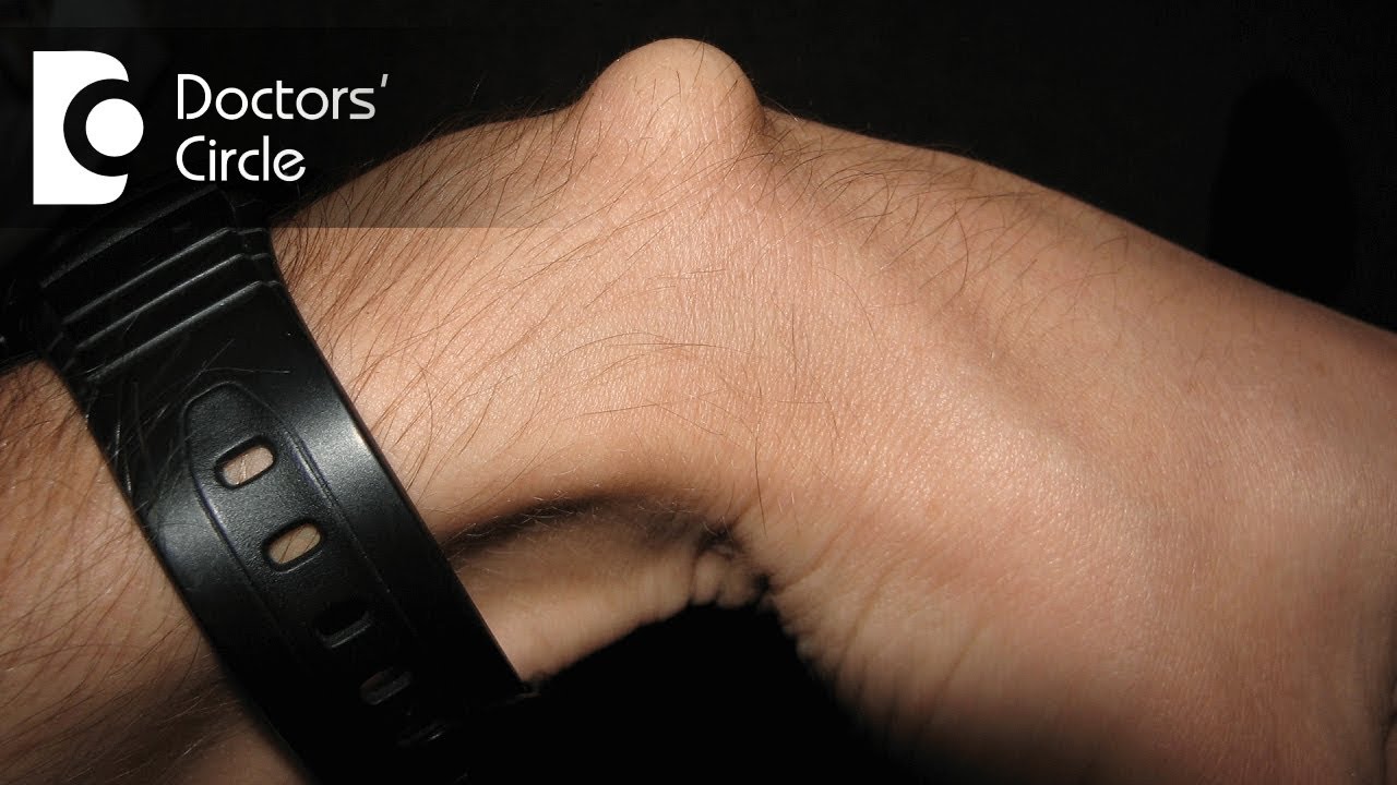 What is diagnosis and management for knots in hands? - Dr. Hanume Gowda ...