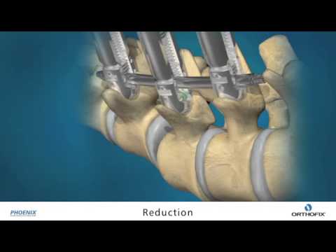 Minimally Invasive Spinal Fixation - YouTube