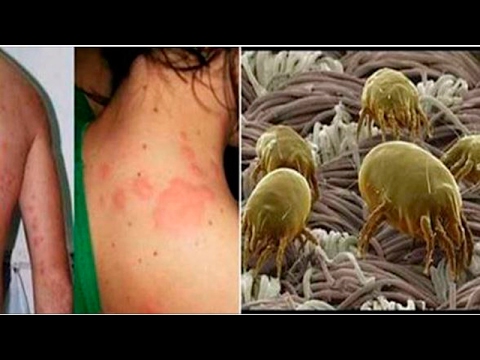 Do not let the mites in your bed or clothes eat you alive Sprinkle this ...