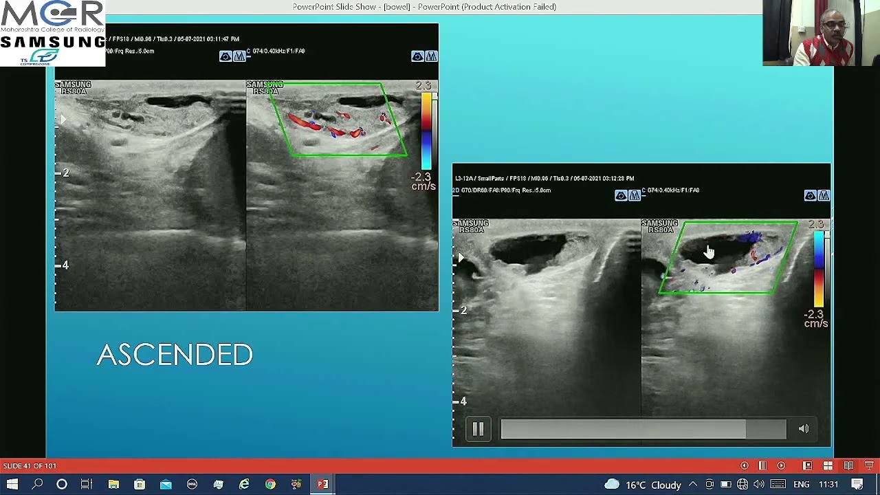 Cryptorchidism Ultrasound
