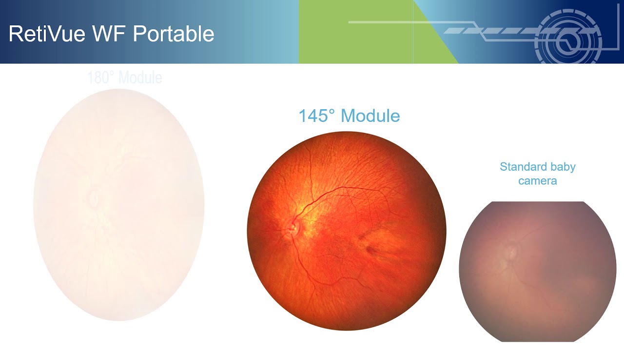Introducing RetiVue widefield retinal photography - YouTube