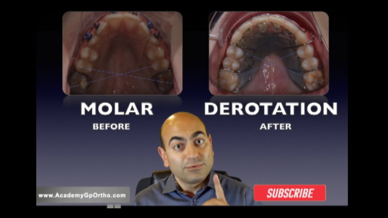Monday Tip: Assessing Rotated Molars - YouTube