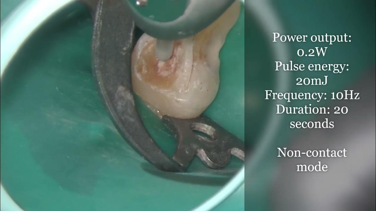 Anterior Direct Pulp Capping by LiteTouch All Tissue Laser - YouTube