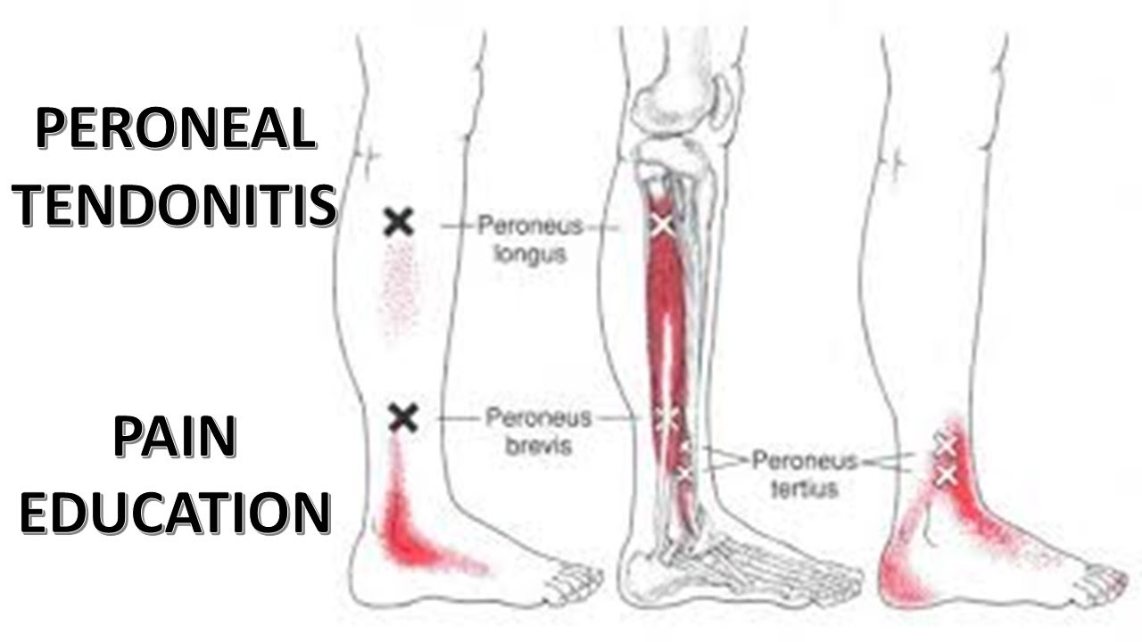PERONEAL TENDONITIS | MY OWN PAIN MANAGEMENT | TUAN TRAN'S TRAINING ...