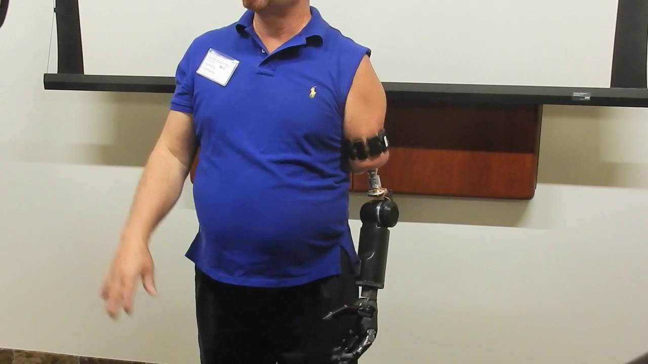 Trans-humeral amputee, s/p TMR with osseointegration bioprosthetic ...