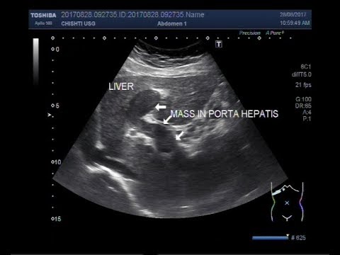 Porta Hepatis Lymph Node