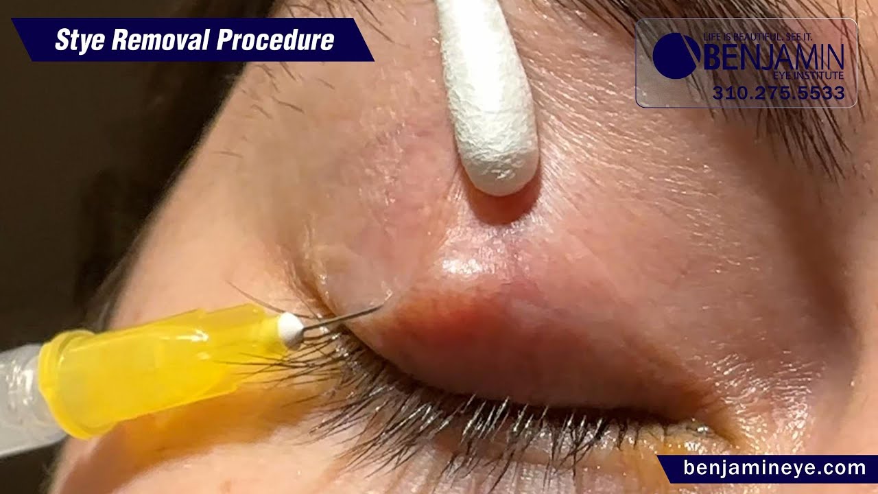 Stye Treatment: Real Procedure, Real Laughs at Benjamin Eye Institute ...