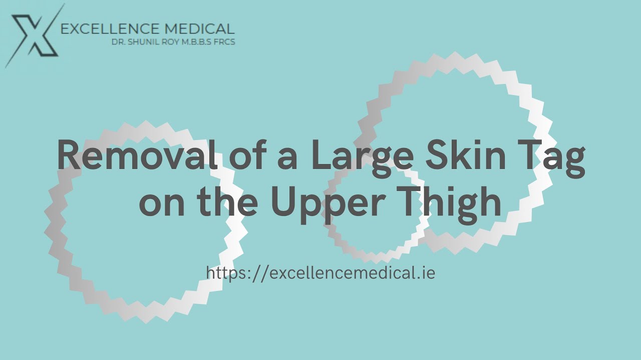 Removal of Large Skin Tag on the Upper Thigh/Groin area, at Excellence ...