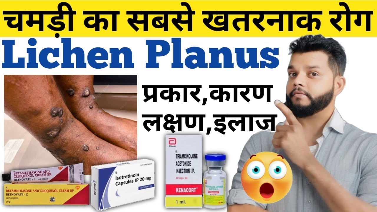 सालों से परेसान है लोग इस चर्म रोग से | Lichen Planus Skin Disease ...