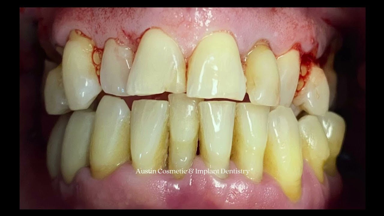 Dental Implants - Step-by-step Guide for a Perfect Smile | All on 4 ...