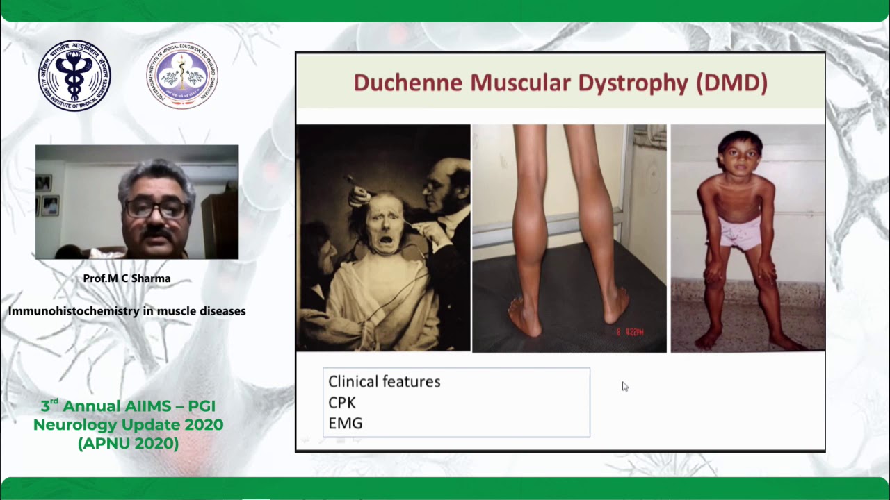 3rd Annual AIIMS-PGI Neurology Update 2020 -Prof.M.C.Sharma ...
