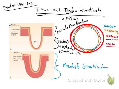 True and False Diverticula - YouTube
