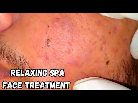 sac be spa blackheads elderly 2024 | satisfying relaxing with everyday ...