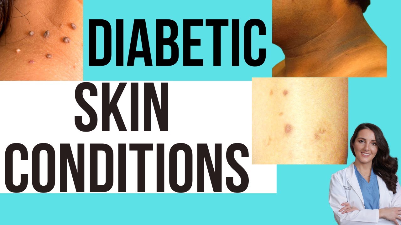 Diabetes Skin Conditions! Signs You May Have Diabetes - YouTube