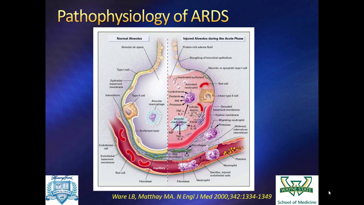 Ventilatory Management of ARDS - YouTube