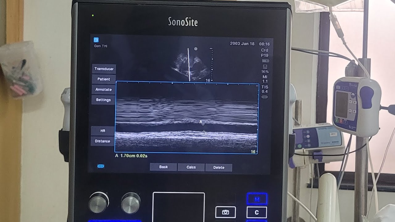 "Role of Bedside ECHO & Chest USG in ICU: A Game-Changer for Critical Care" - YouTube