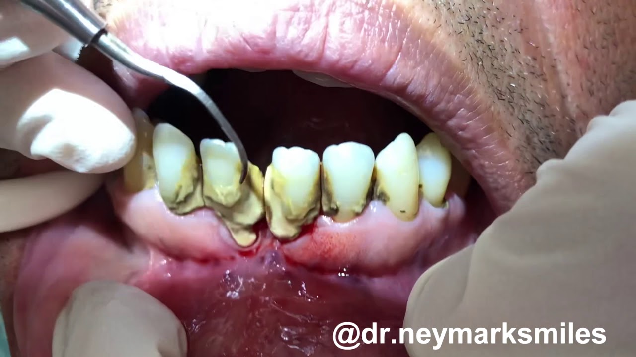 Rise and Debride - YouTube