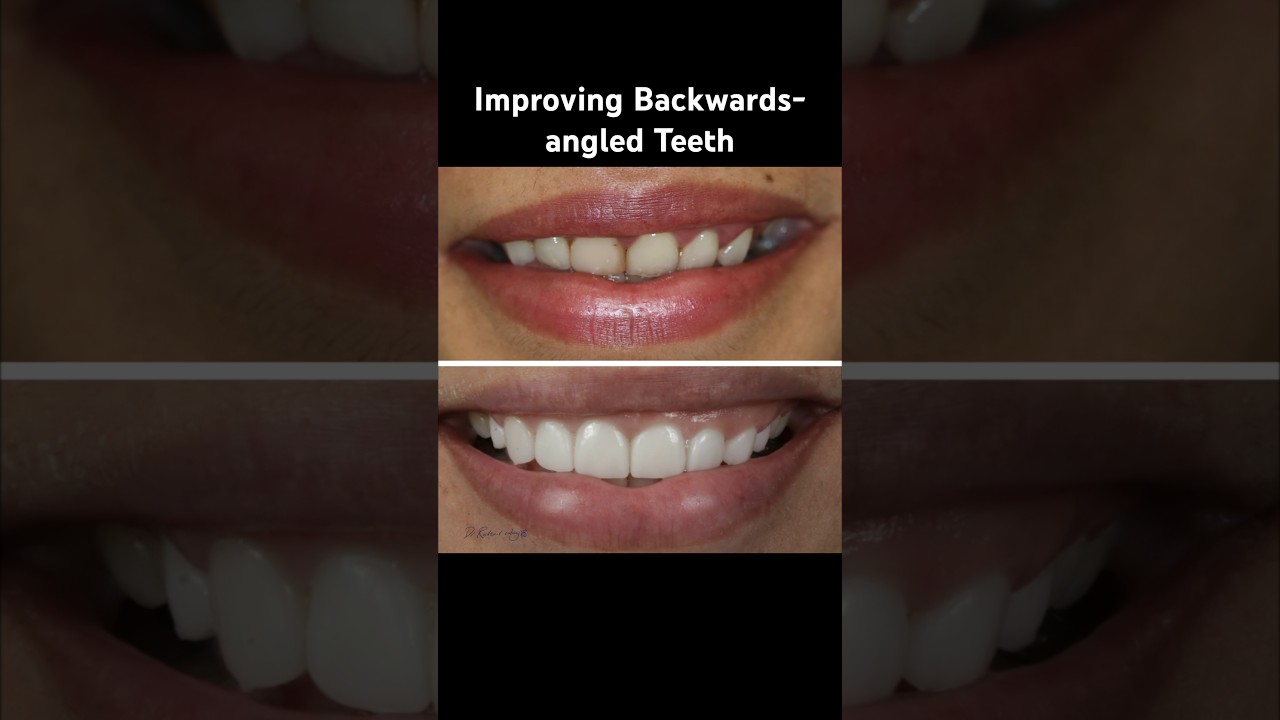 How to Fix Backwards Angled Teeth with Veneers / Crowns, 8 x Teeth ...