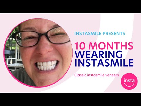 instasmile 10 month update | Clip on veneers | classic BL1 instasmile ...