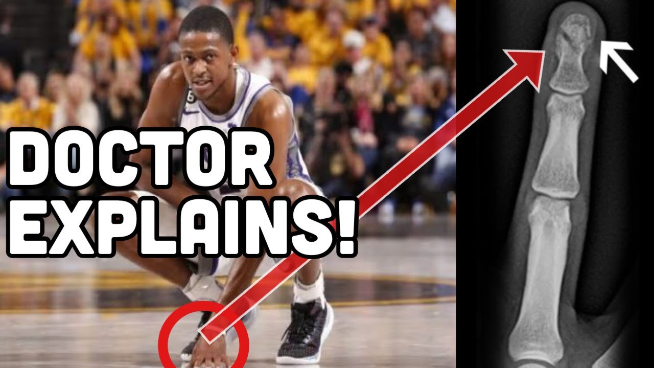 De'Aaron Fox' INSIDIOUS Finger Fracture | How Long is he OUT? | DOCTOR ...