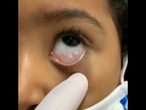 Conjunctival Cyst - YouTube