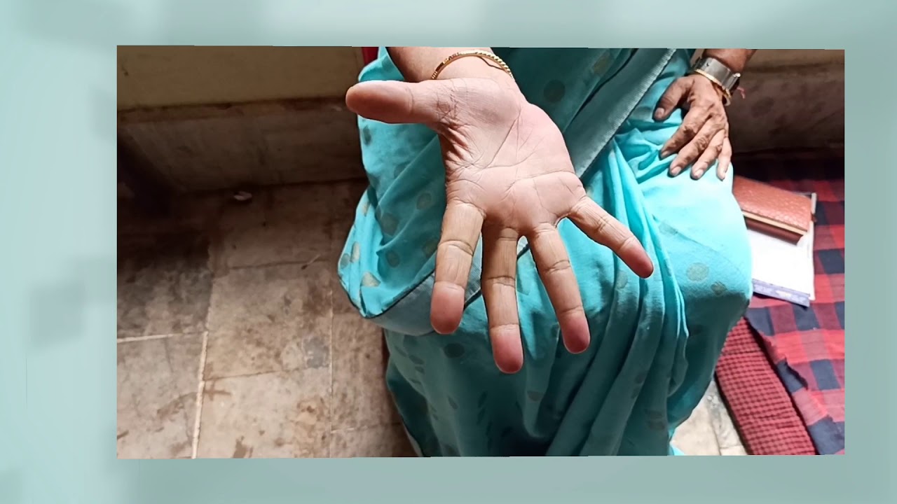 Middle trigger finger problem solved by Dr Saurabh Chiropractor - YouTube