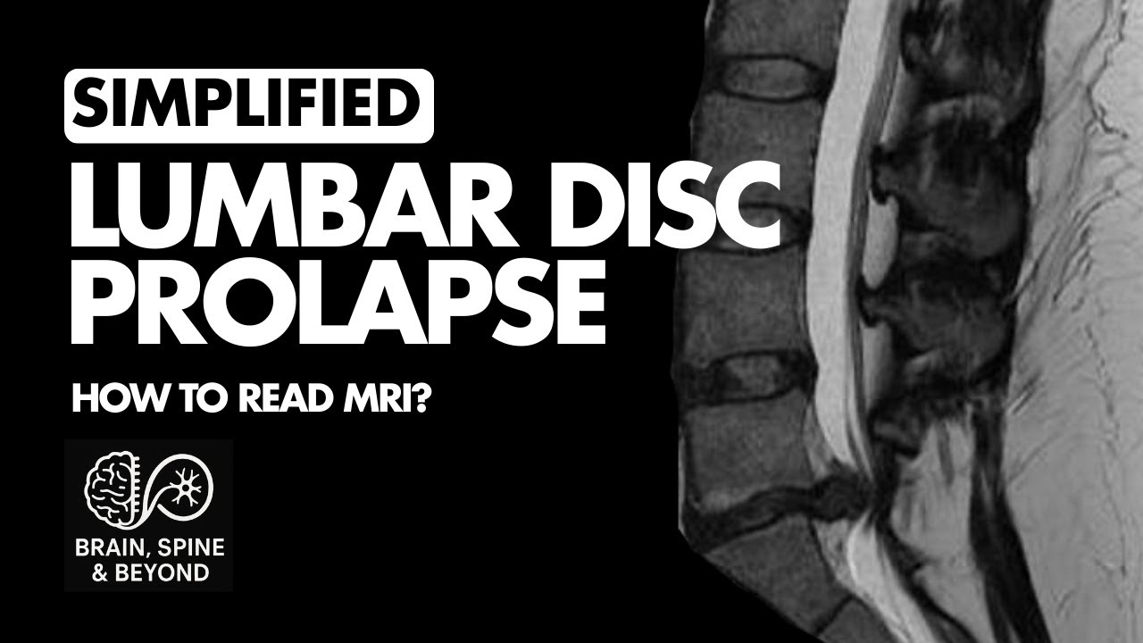 How to Simply Identify Lumbar Disc Prolapse on MRI Scan? - YouTube