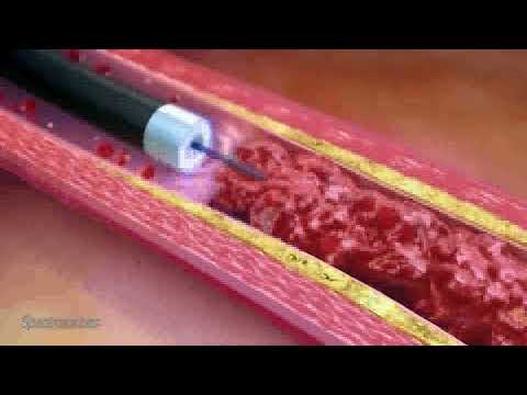 エキシマレーザー冠動脈形成術（ELCA） - YouTube