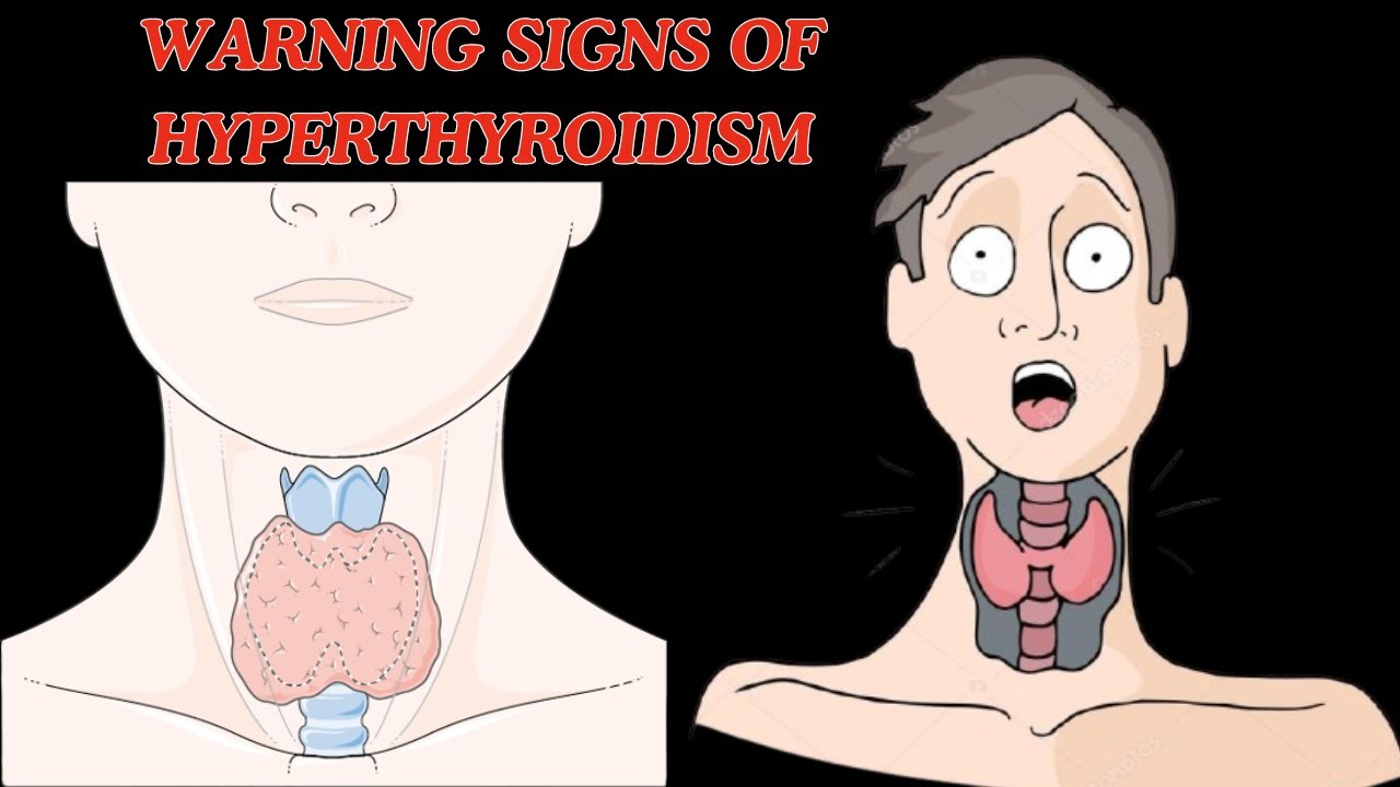 Warning Signs of Hyperthyroidism | Hyperthyroidism Symptoms - YouTube