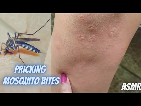 Itch Mosquito bite |prick bump|#popping satisfying visual asmr# ...