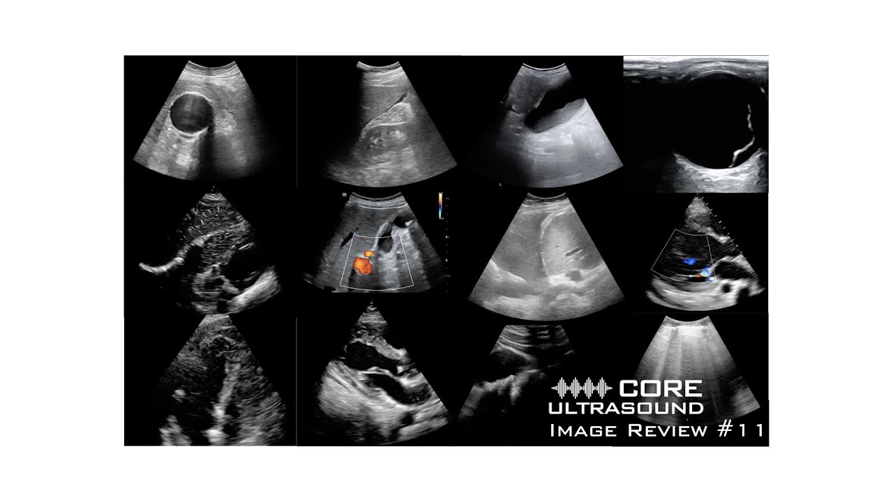Core Ultrasound Image Review, Episode 11! - YouTube