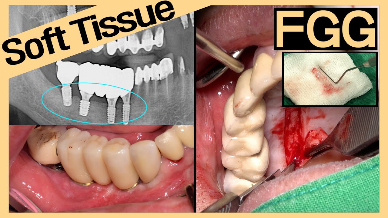 [Online Surgery] Soft tissue management to improve oral hygiene (FGG ...