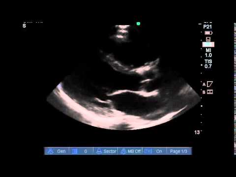 Normal systolic function - YouTube