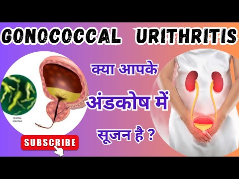 Gonococcal Urethritis,#gonorrhea, Gonococcal Urethritis Natural and ...