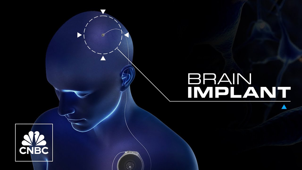 Could brain implants help patients speak again? - YouTube