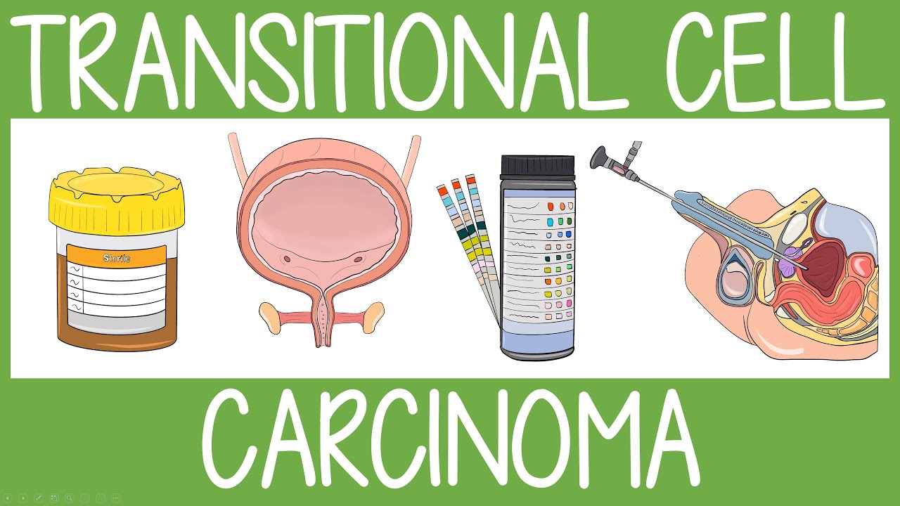 Transitional Cell Carcinoma Visually Explained - YouTube