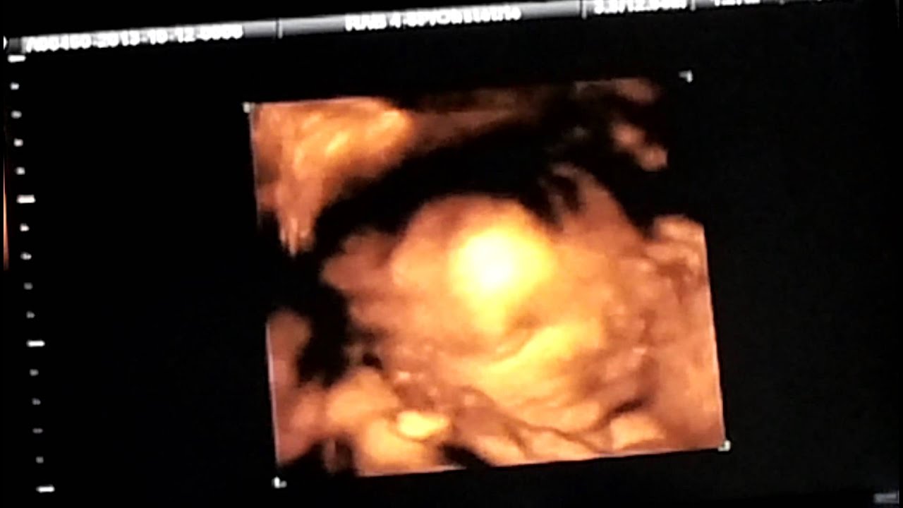 3D/4D Ultrasound 30 Weeks 2 Days Pregnant - YouTube